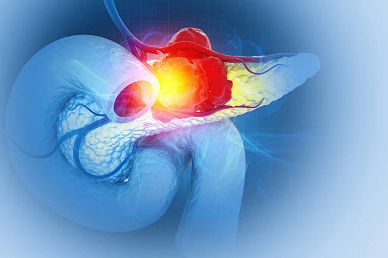 IDEAYA to work with Roche on combo pancreatic cancer treatment