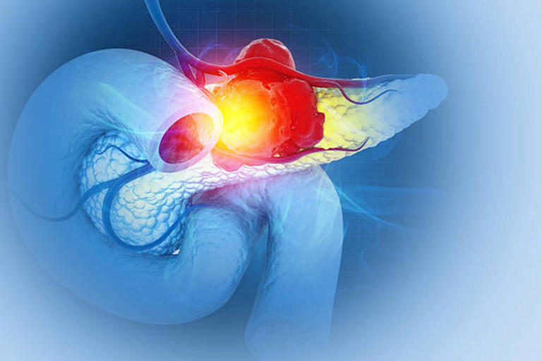 Revolution Medicines surges on data for pancreatic cancer asset ...