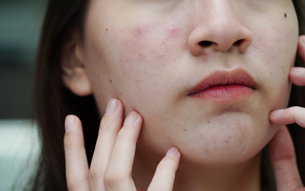Significant increase in acne among young adults, new figures show
