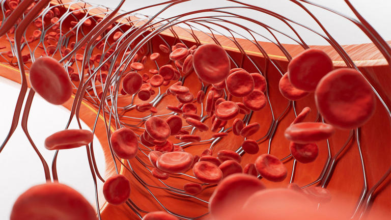 Stenting eases hard-to-treat venous disease after deep vein thrombosis