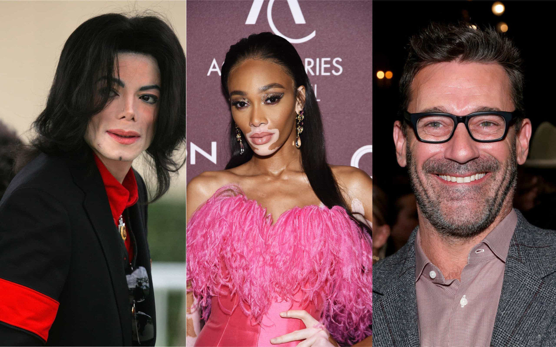 Celebrities who have vitiligo