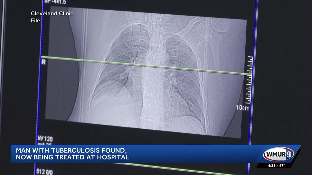 Man with tuberculosis found, taken to hospital