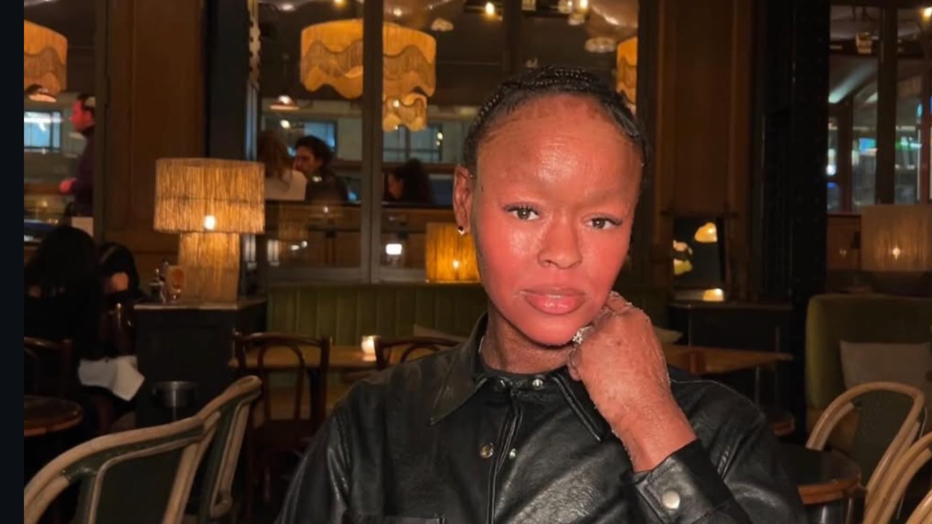 Suffering from a skin condition, this model redefines beauty standards ...