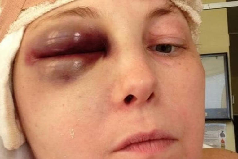 Scots women facing brain tumours after contraceptive jags call for ...