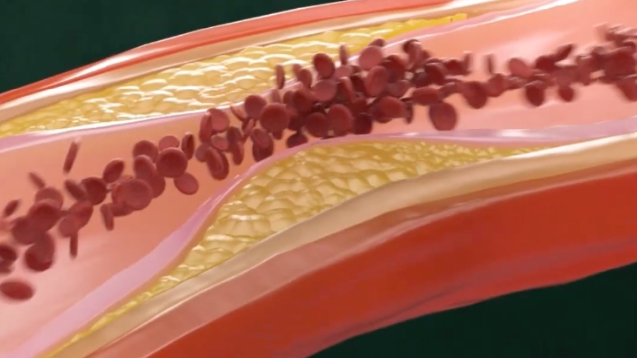 LDL is like oxygen? The analogy that changes the conversation