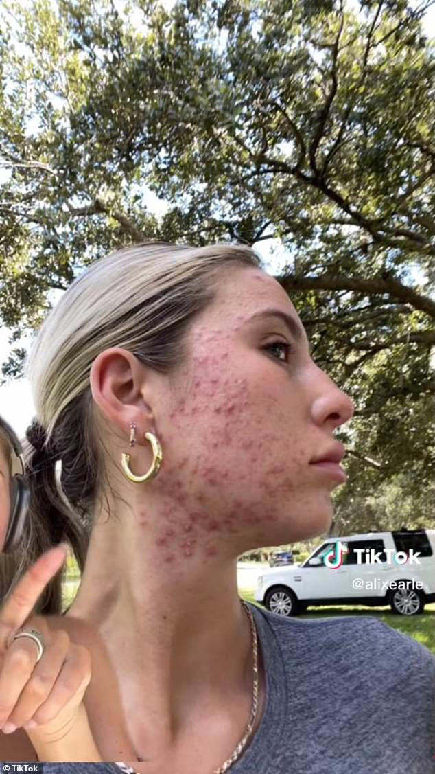 Fans slam Alix Earle's skincare line after uncovering the truth