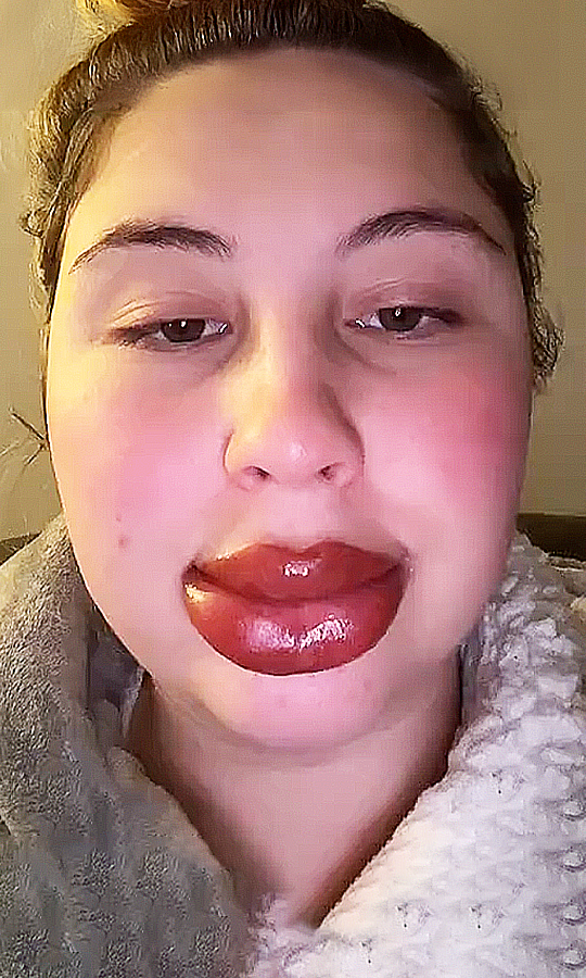 TikTok's dangerous lip trend 🚨