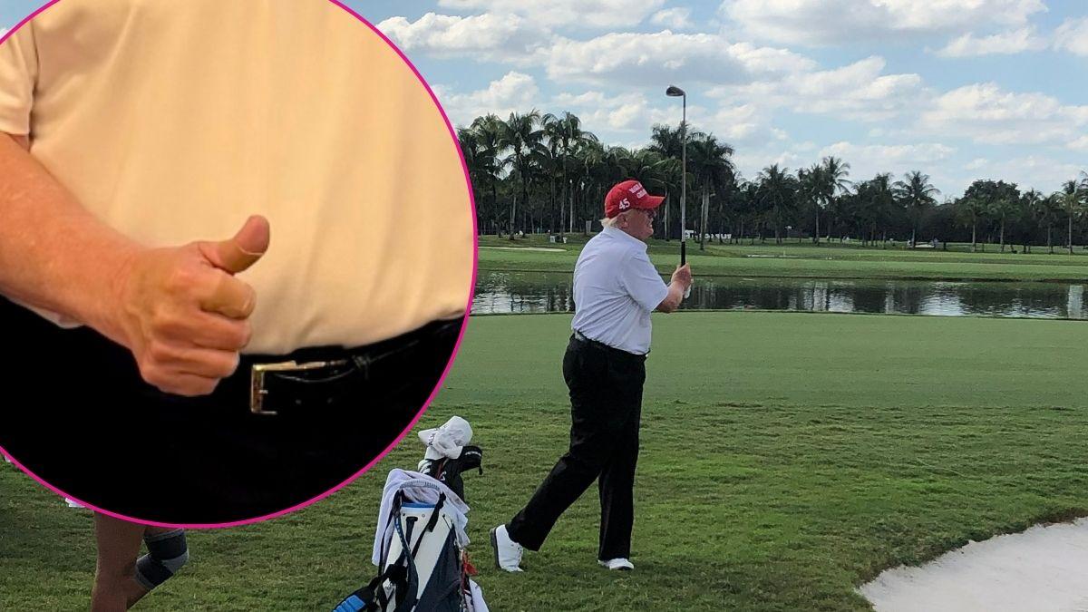 Donald Trump's bandages and bruises spark health speculation: What ...