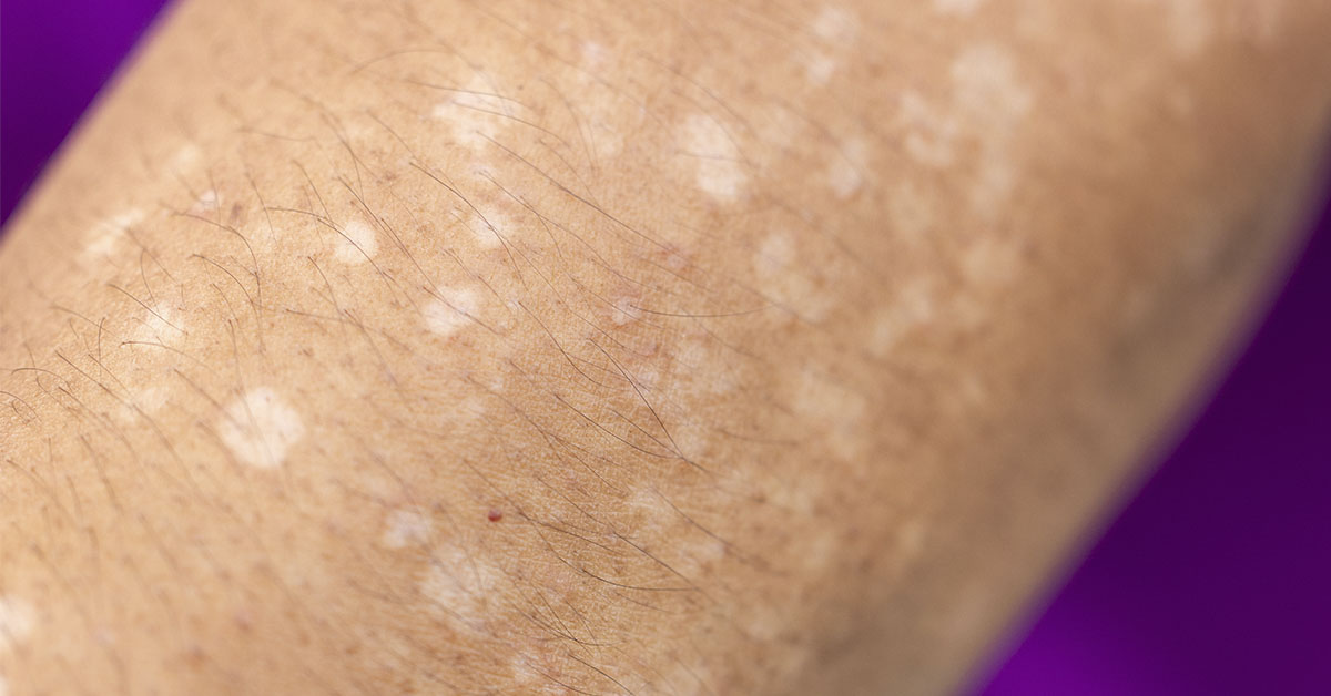 Notice these small white spots on your arms or legs? Most people have ...