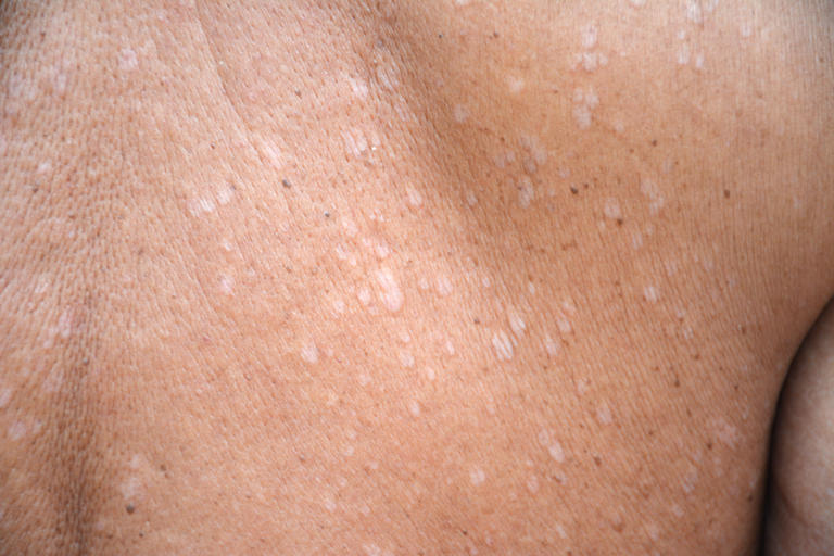 Notice these small white spots on your arms or legs? Most people have ...