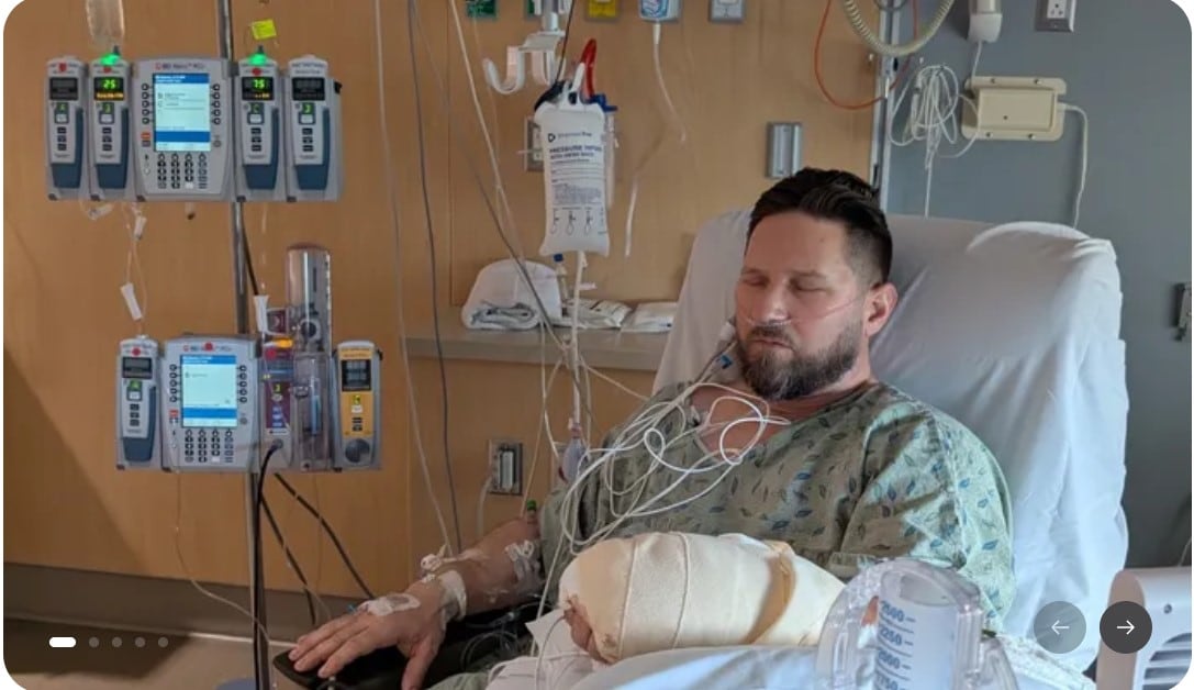 Snohomish County man loses half his hand in ATV crash; recovering from ...