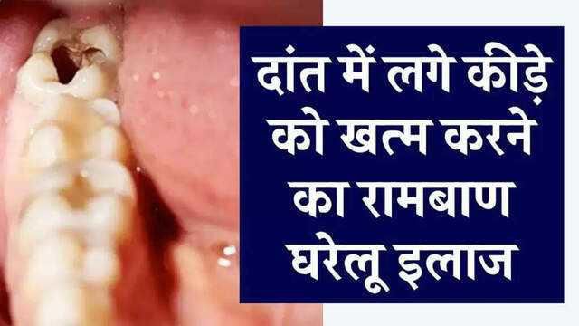 Effective home remedies to treat tooth cavities