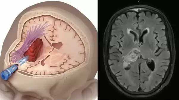 Understanding mini strokes: Symptoms and prevention
