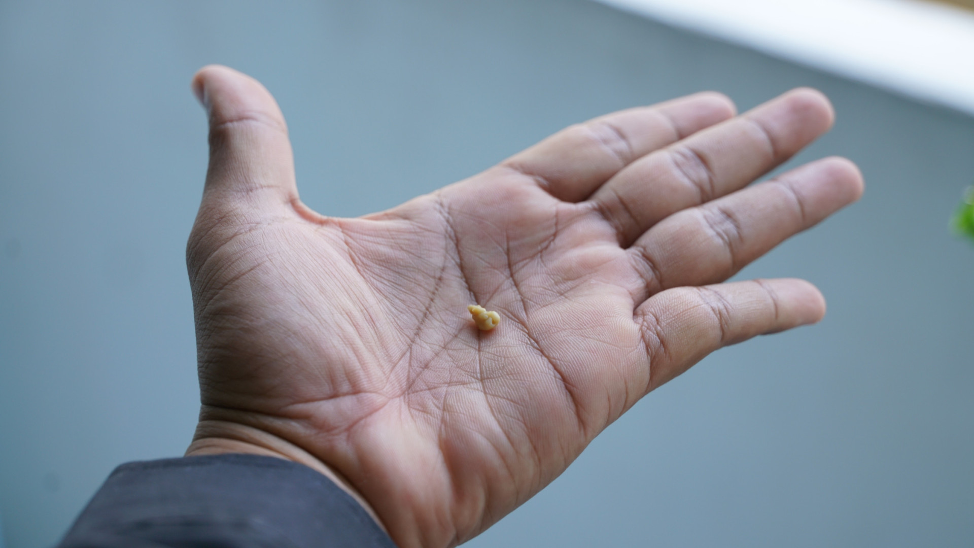 Why you might have tonsil stones and not even know it