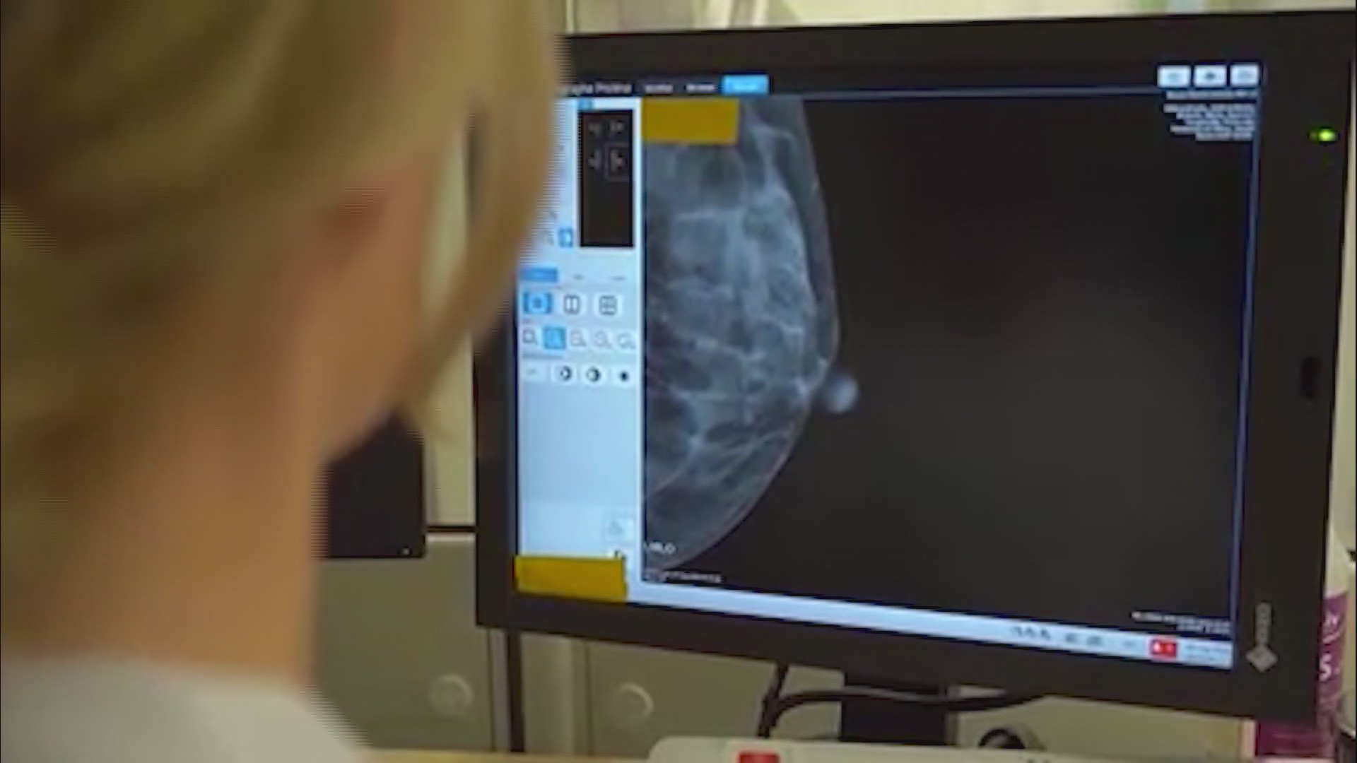 Northwestern Medicine doctor warns new mammogram guidelines could ...