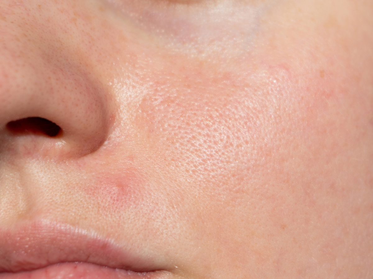 Struggling with visible pores? Understand why Indian skin is different