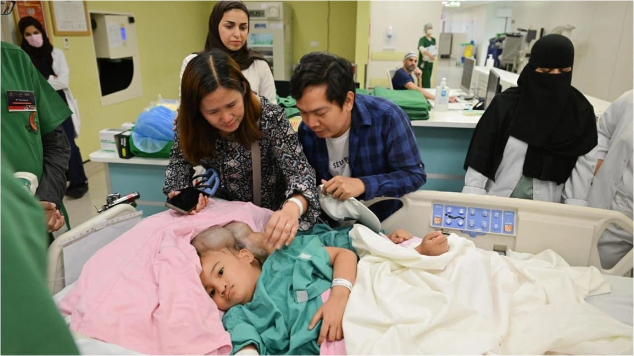 Conjoined twins surgery: Riyadh doctors begin risky 24-hour surgery to ...