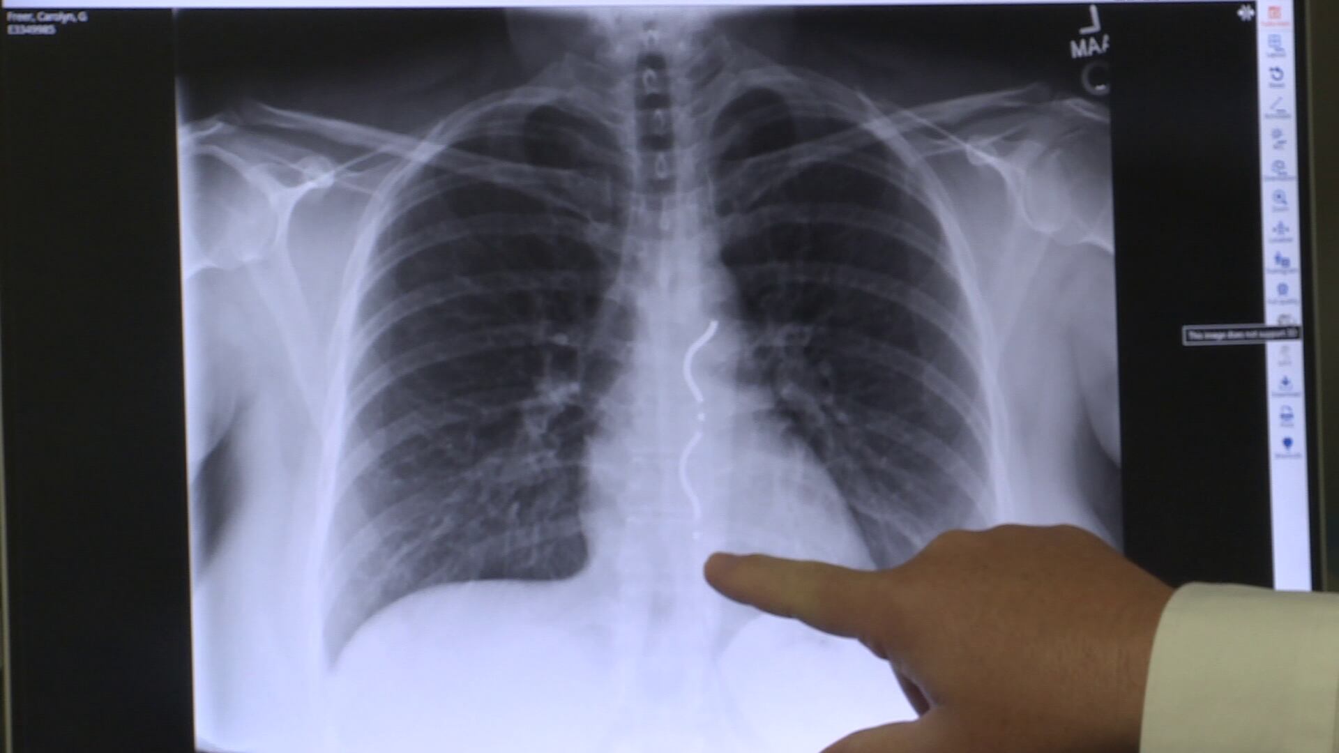 A first in North Dakota: a new defibrillator implant