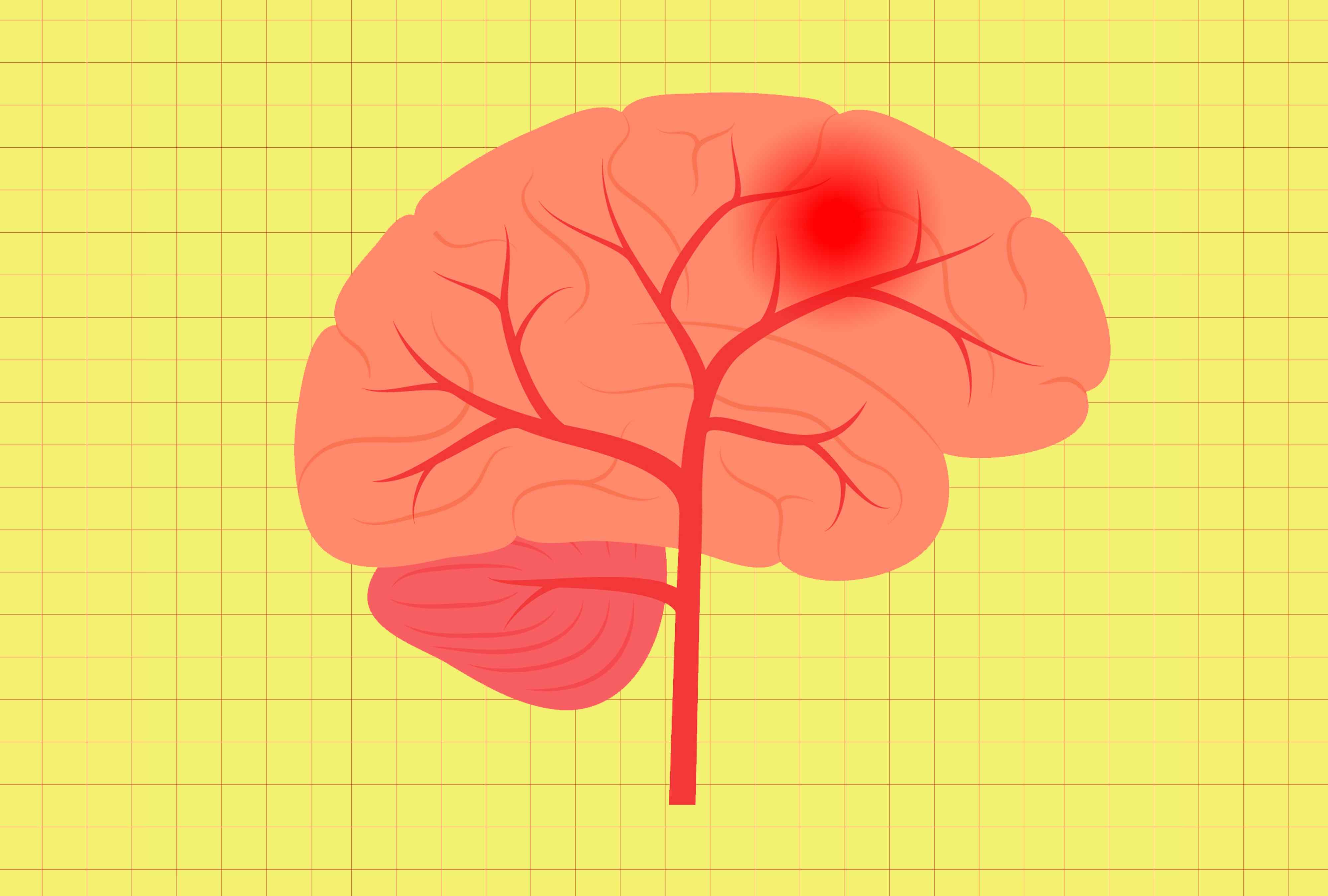3 surprising habits that could raise your stroke risk, according to a ...