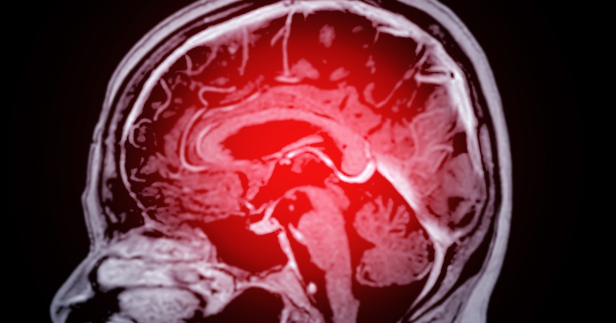 Surprising new research reveals what's really raising your dementia risk