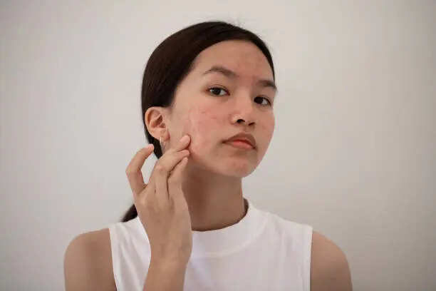 Can’t get rid of acne? Your smoking habit might be the real culprit