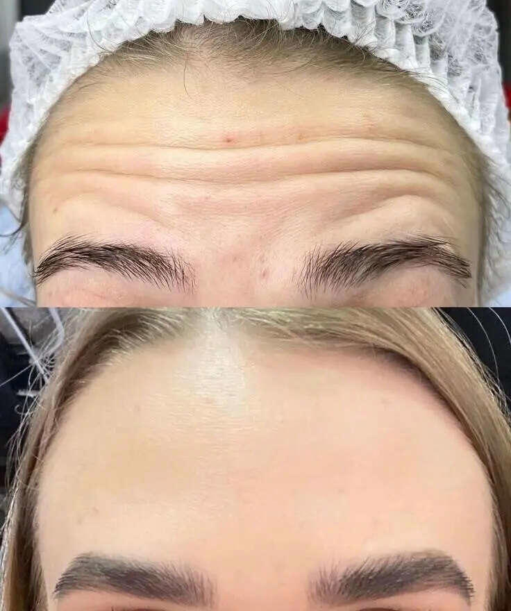 Botox isn’t enough anymore: New anti-ageing trend doctors swear by in 2026