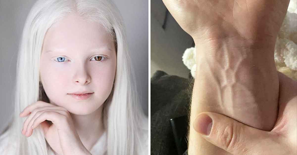 29 people share the rare genetic anomalies that make them unique