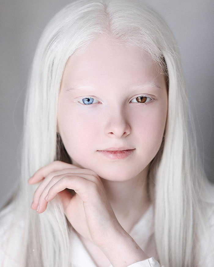 29 people share the rare genetic anomalies that make them unique