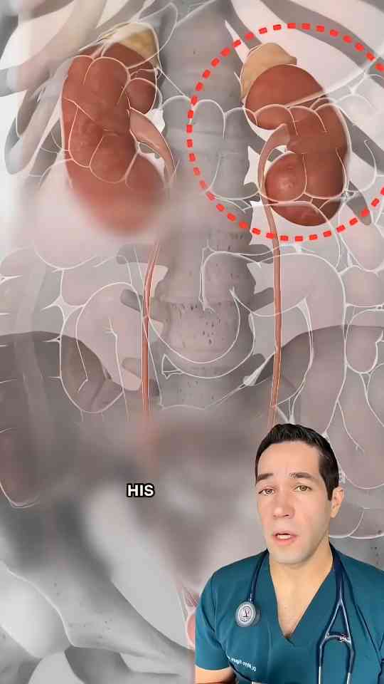Doctor shows what kidney failure looks like