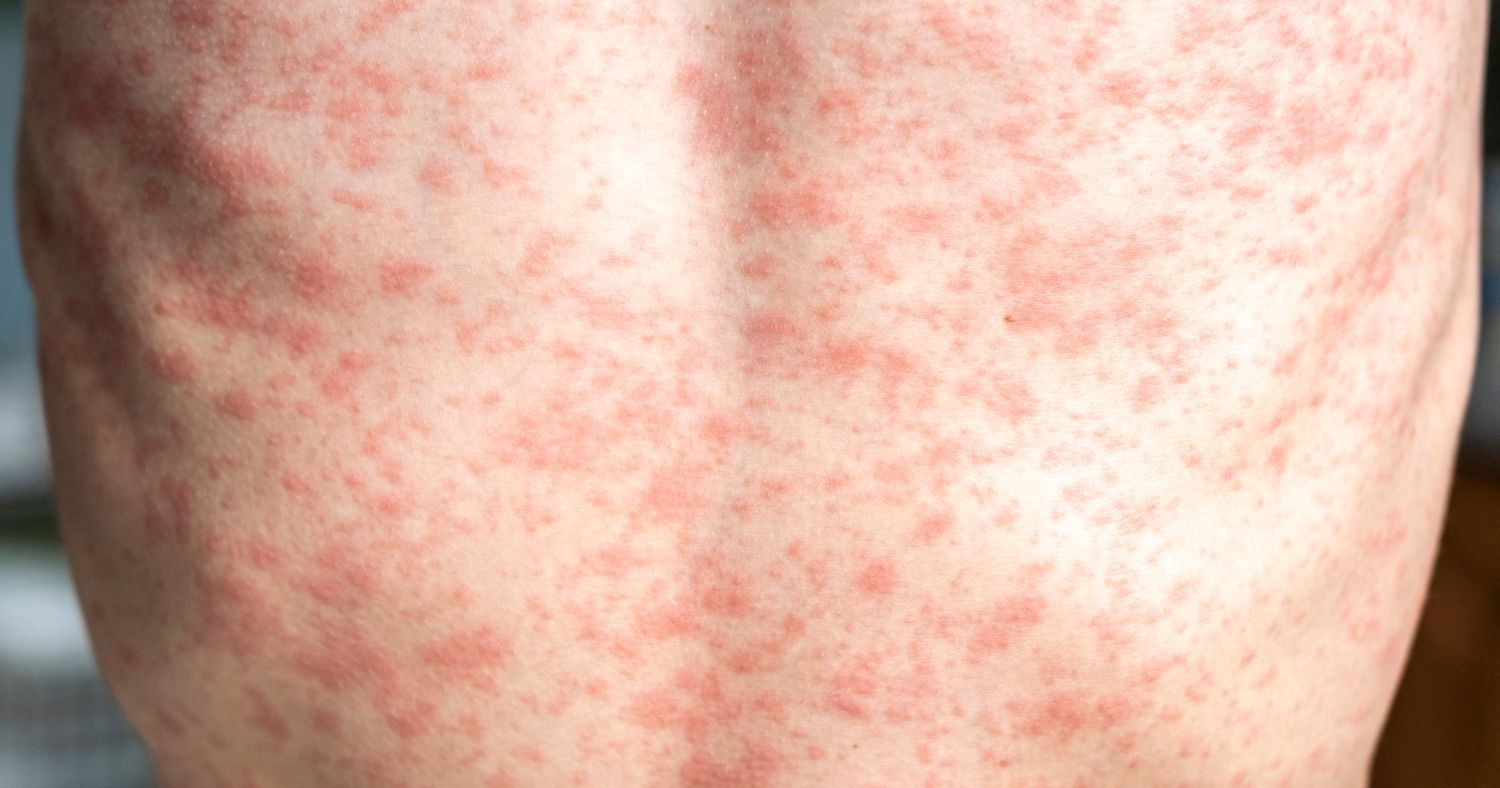 Arizona measles outbreak prompts surveillance toolkit