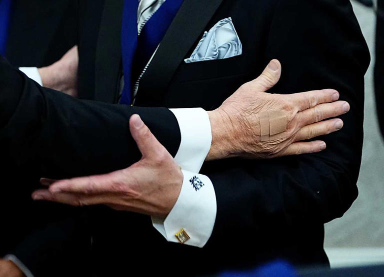 Trump’s ‘left-hand discoloration’ resurfaces in photos with King ...