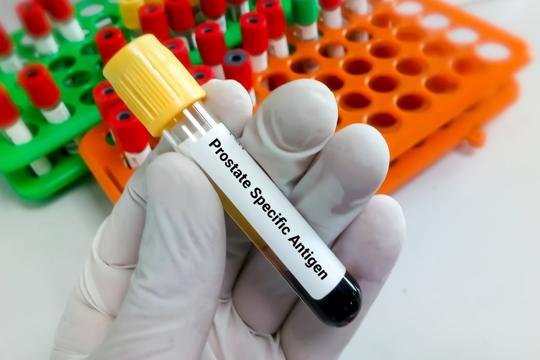 Prostate cancer overdiagnosis risk sharply rises after age 70 – new ...