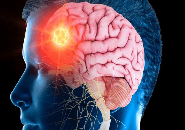 Brain stroke warning signs: Early symptoms you should never ignore to ...