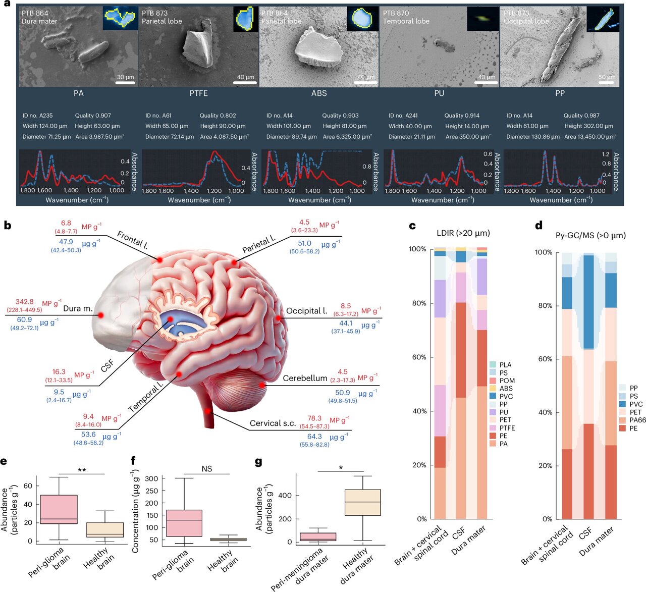 Microplastics turn up in nearly every human brain sample, including ...