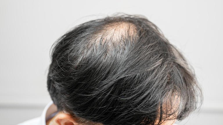 Veradermics reports late-stage win for hair-loss pill, setting up ...