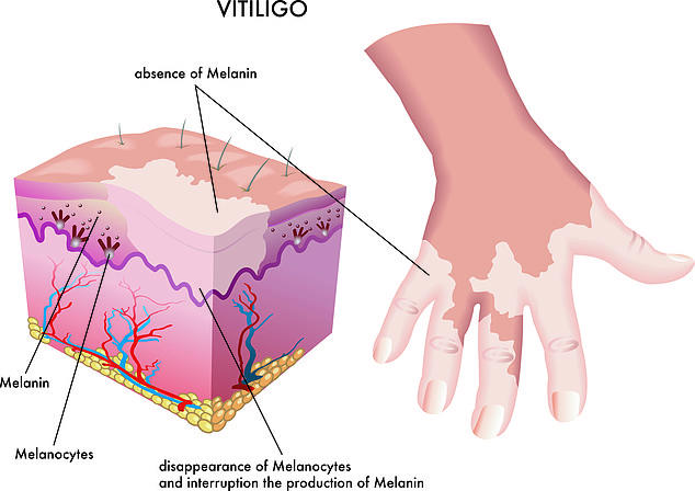 What is vitiligo? The skin condition that changed Michael Jackson's ...