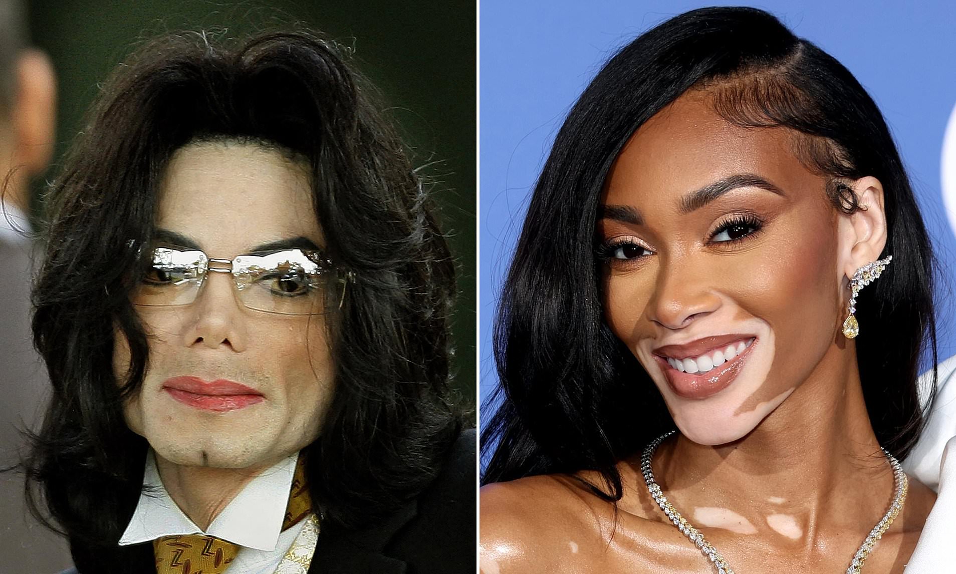 What is vitiligo? The skin condition that changed Michael Jackson's ...