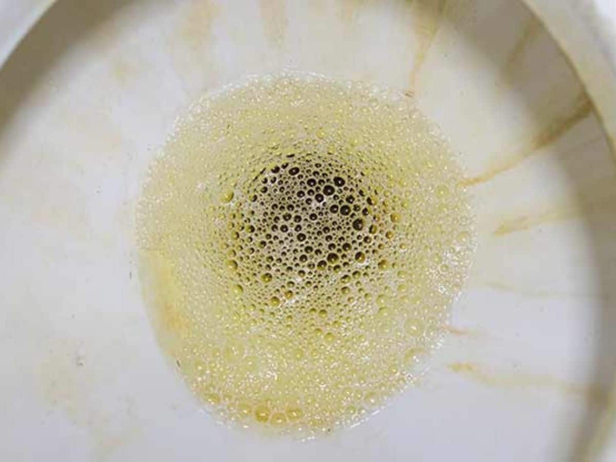 5 urine changes that could signal early kidney damage you shouldn’t ignore