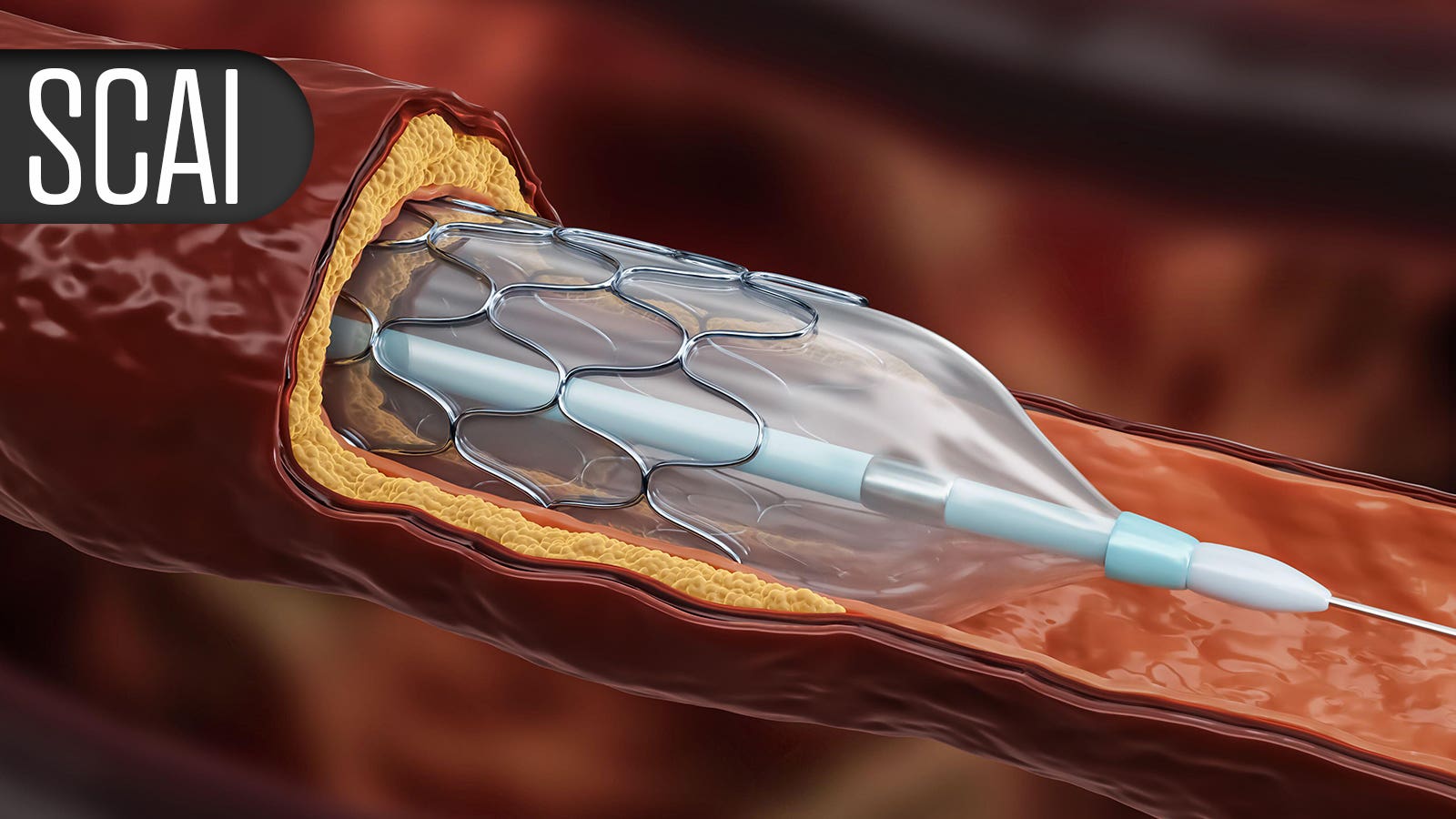 COVID-19 at time of heart attack linked to higher mortality risk