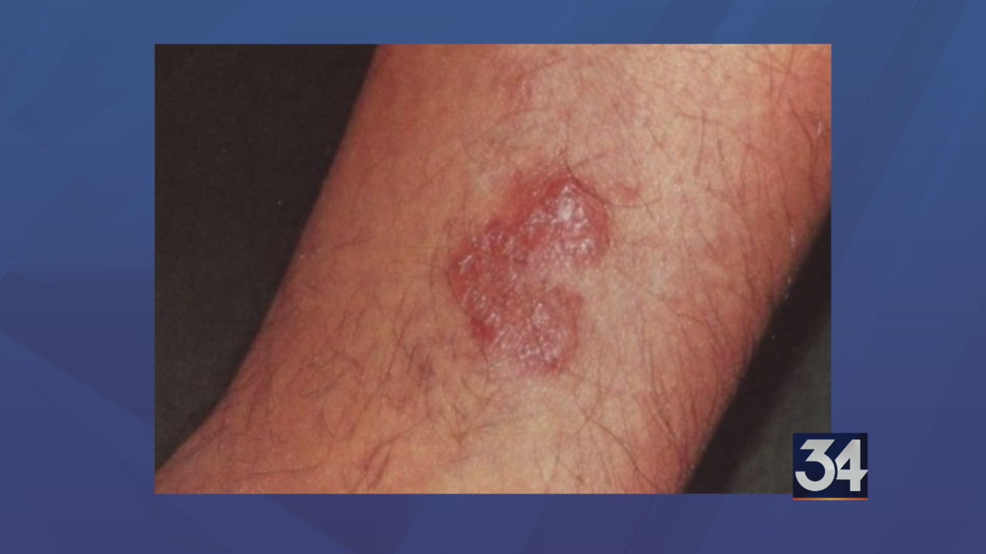 Syphilis cases are on the rise in Broome County