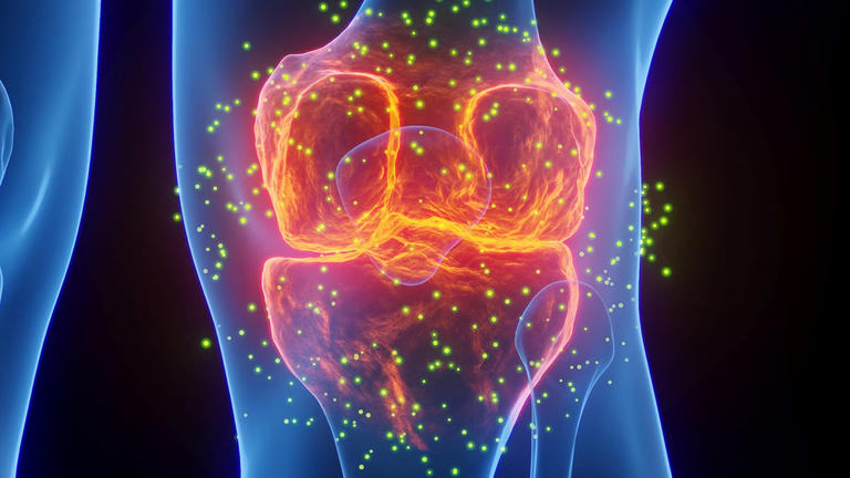 Common gout medications linked to lower risk of heart attack and stroke