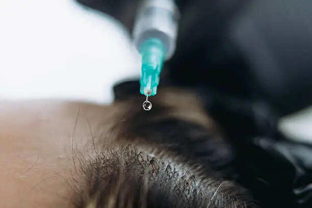 How to reverse hair loss with microneedling and rosemary oil
