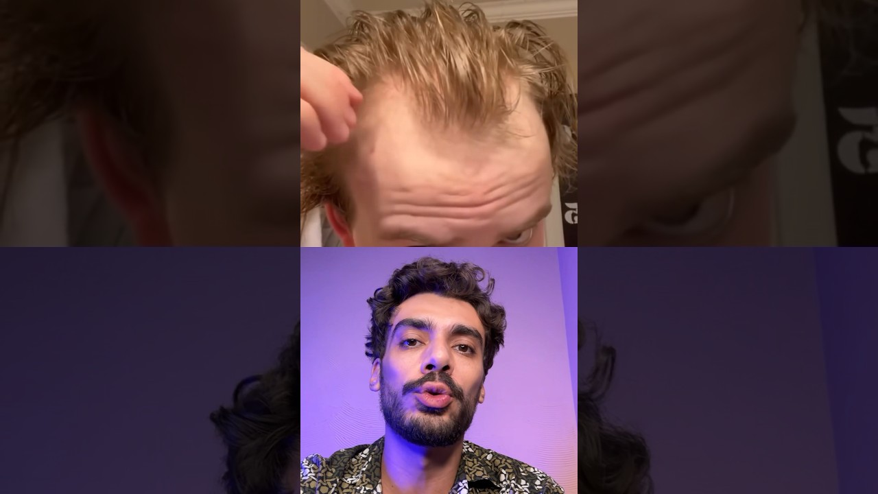 Escondendo entradas no cabelo e calvície #hairstyle #hairloss