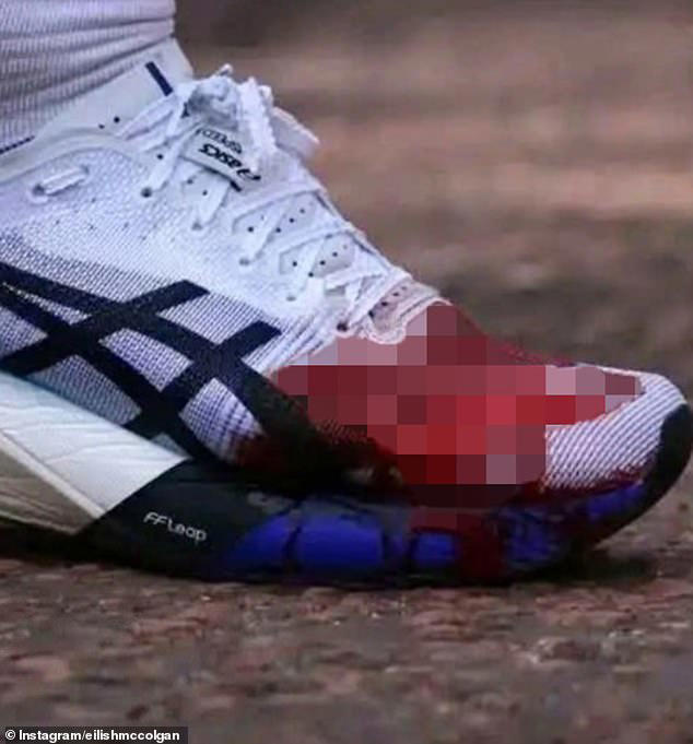 Top British runner posts medal picture two days after ripping open toe