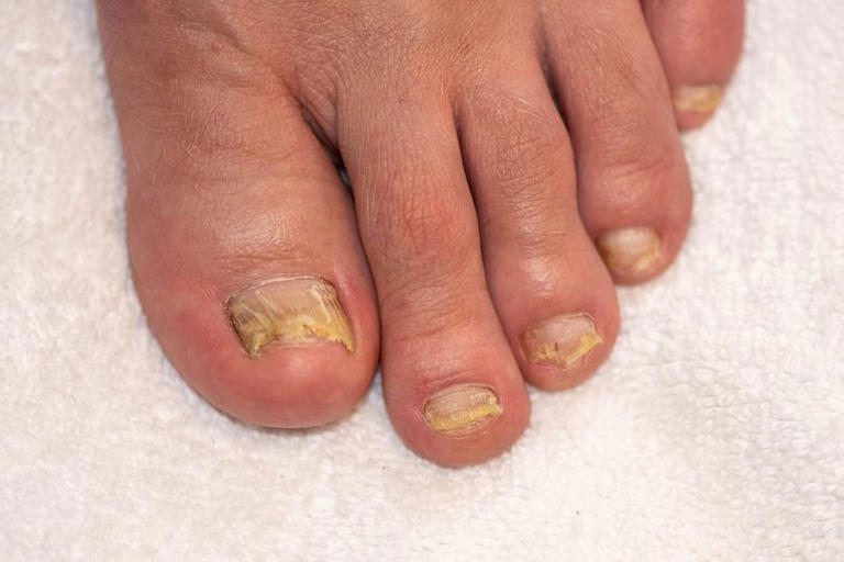 Little-known toenail change that could be potentially deadly cancer