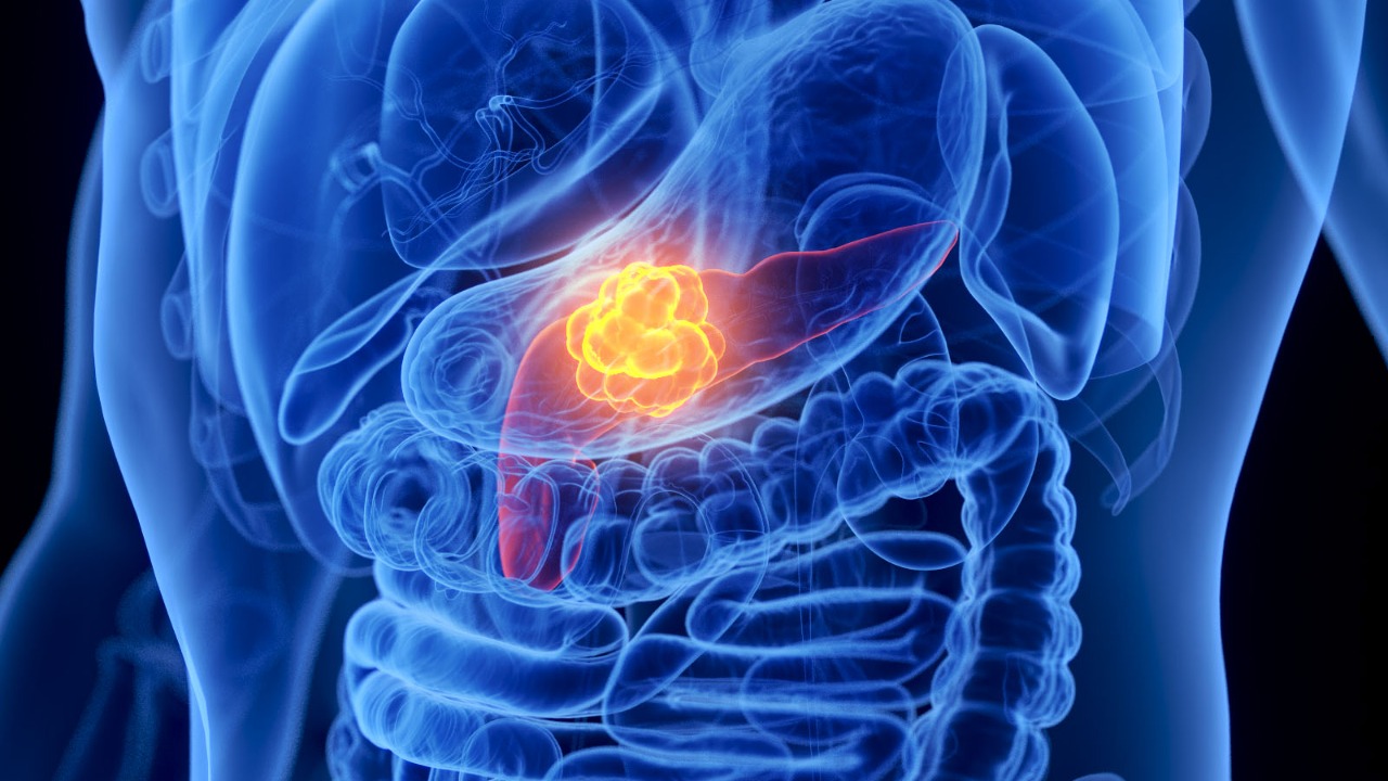 Off-the-shelf CAR-T-style therapy shows promise against pancreatic cancer