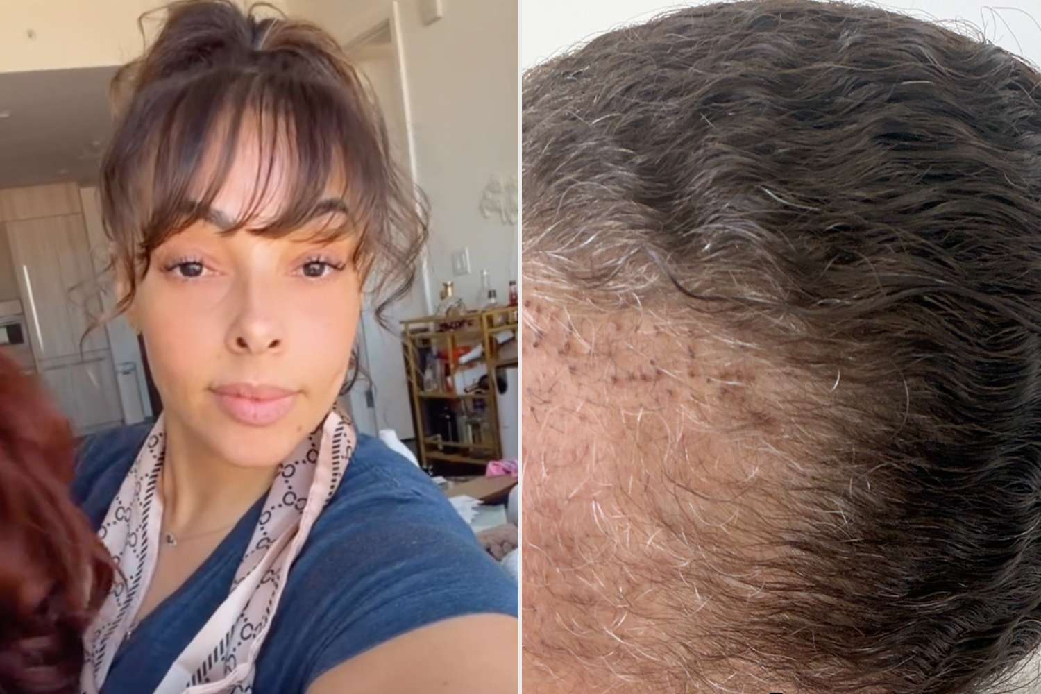 Woman who underwent hair transplant surgery will now be a case study ...