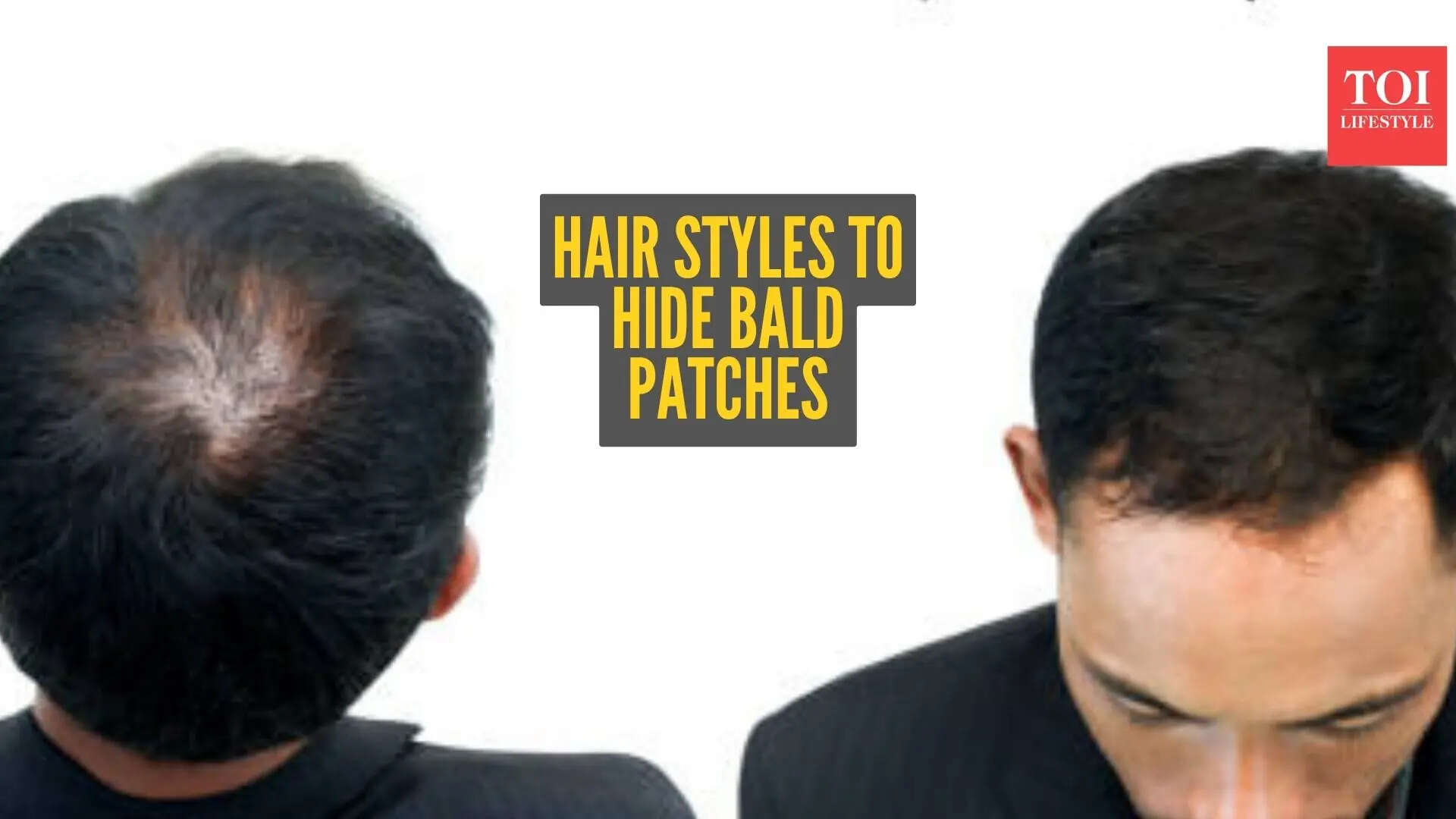Alopecia areata: 5 clever hairstyles to gracefully conceal bald patches