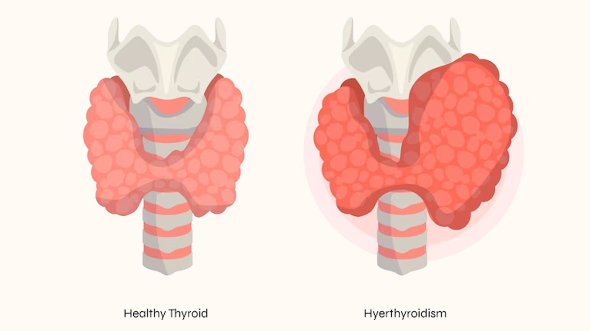 Thyroid and heart disease: What happens when both conditions coexist?