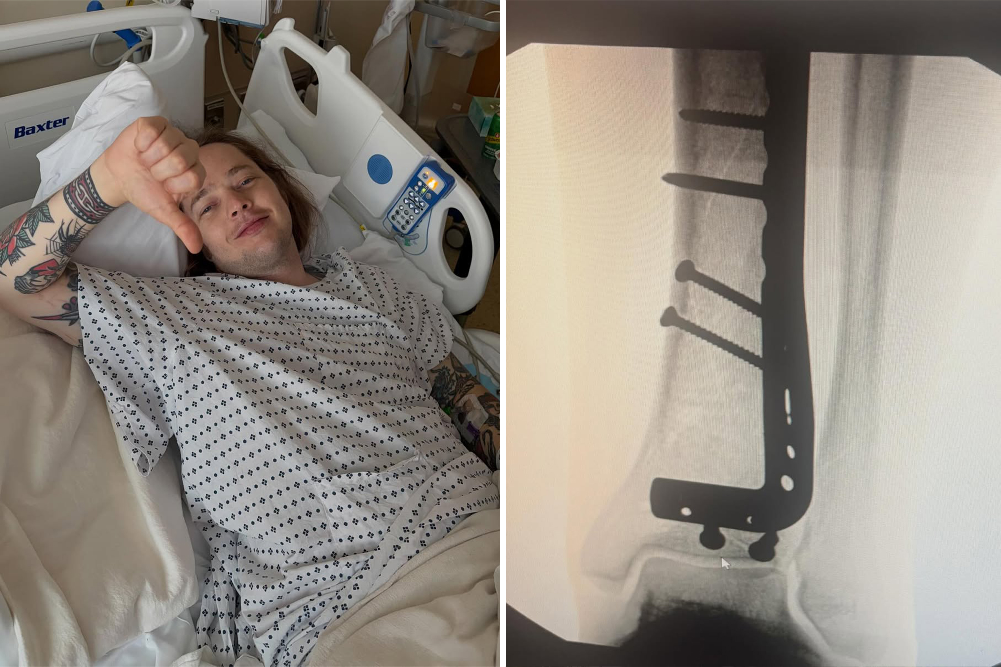 Bluegrass artist Billy Strings breaks leg while skateboarding at his ...